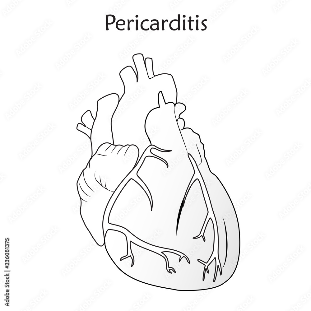 Pericarditis. Inflammation of the pericardium. Damaged heart muscle ...