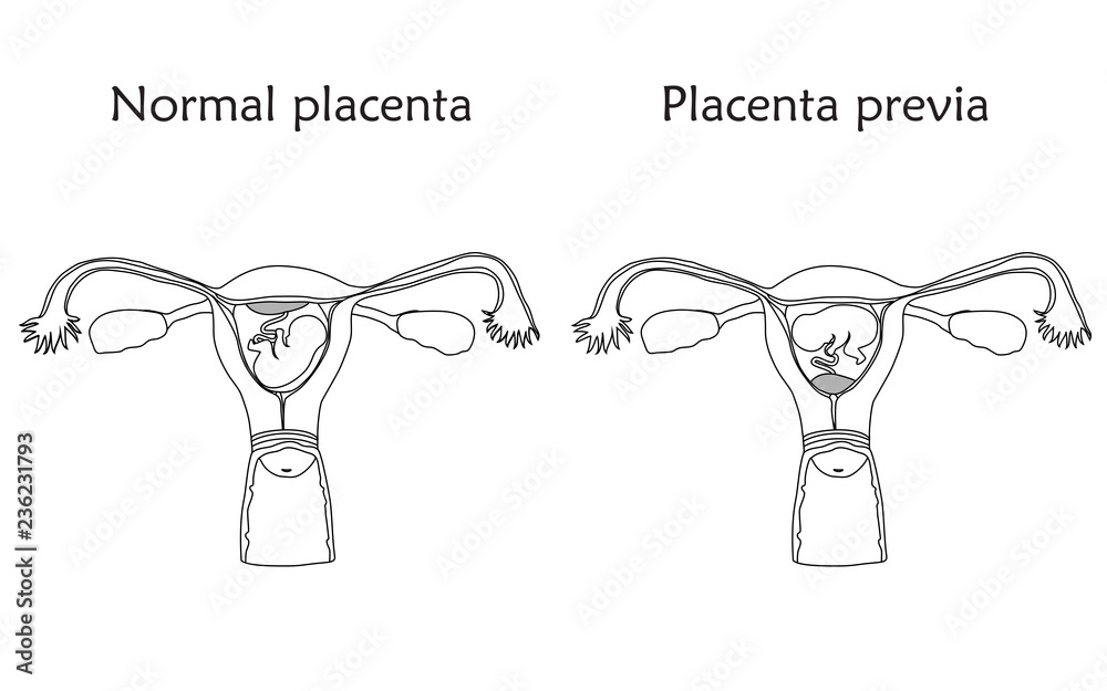 Stock-Vektorgrafik „Placenta previa and normal pregnancy. Embryo, fetus ...