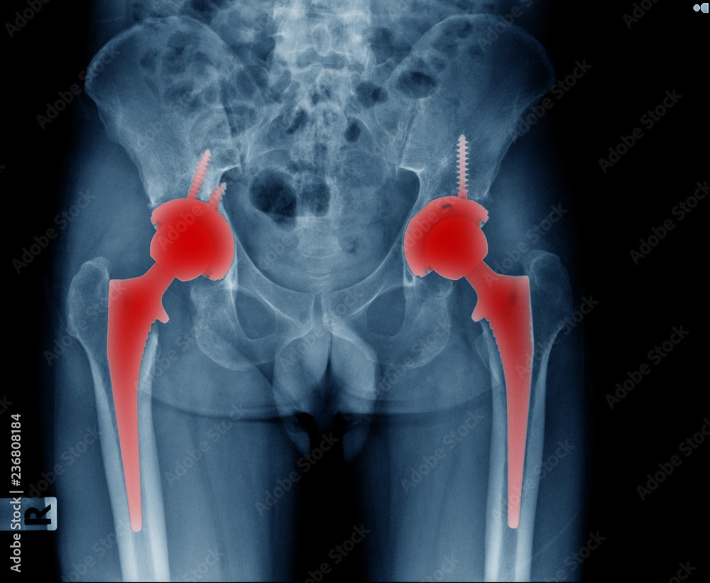 bilateral hip replacement of patient, hight qulity x-ray image of hip ...