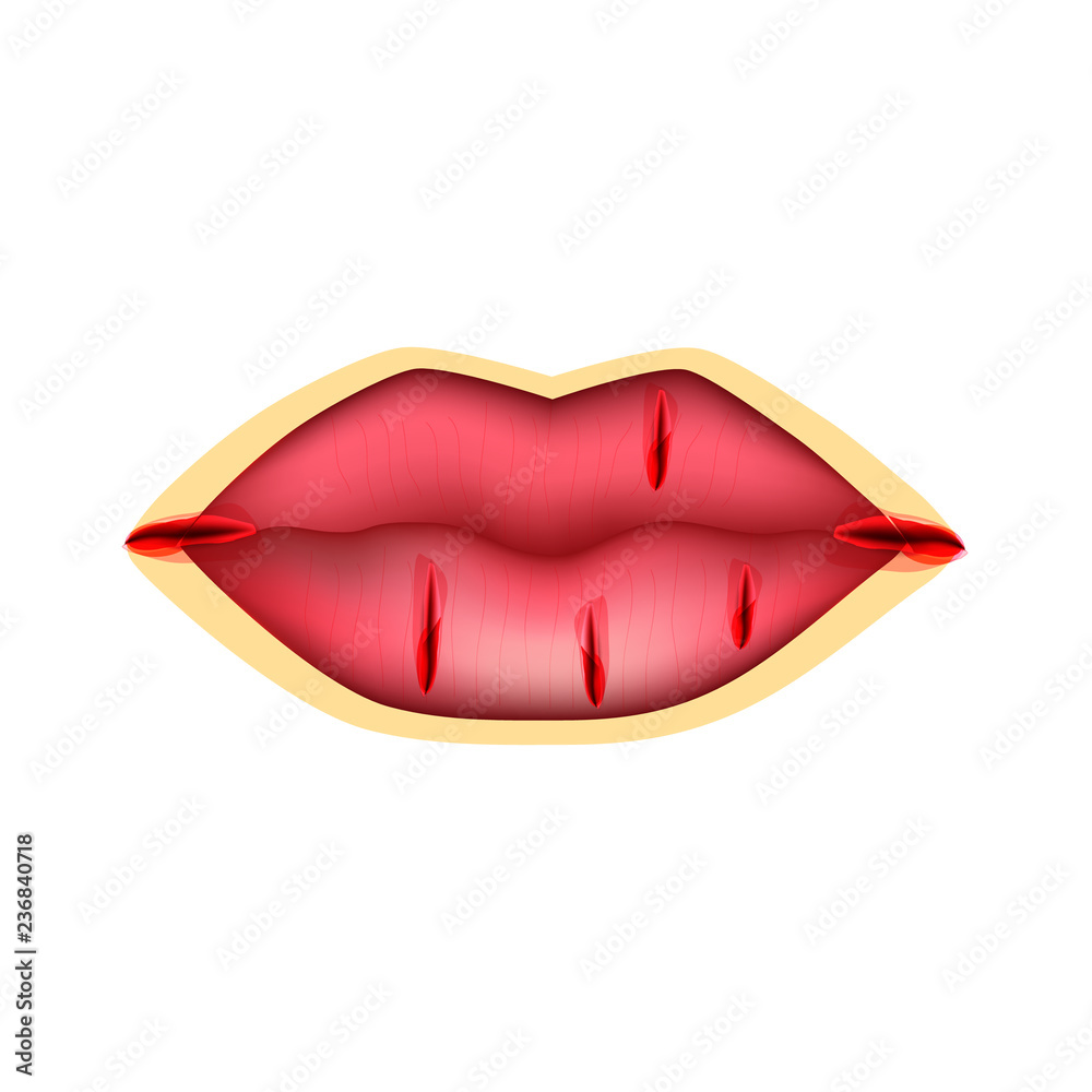 Cracks in the lips. Dry chapped lips. Wounds in the corners of the ...