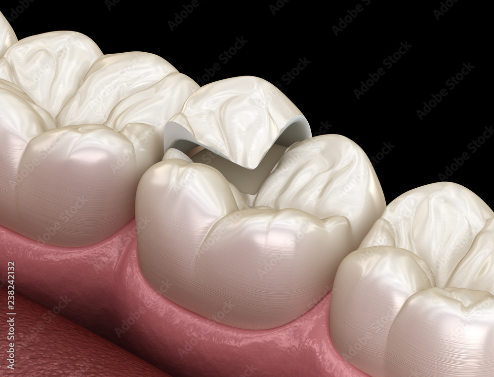 Onlay ceramic crown fixation over tooth. Medically accurate 3D ...