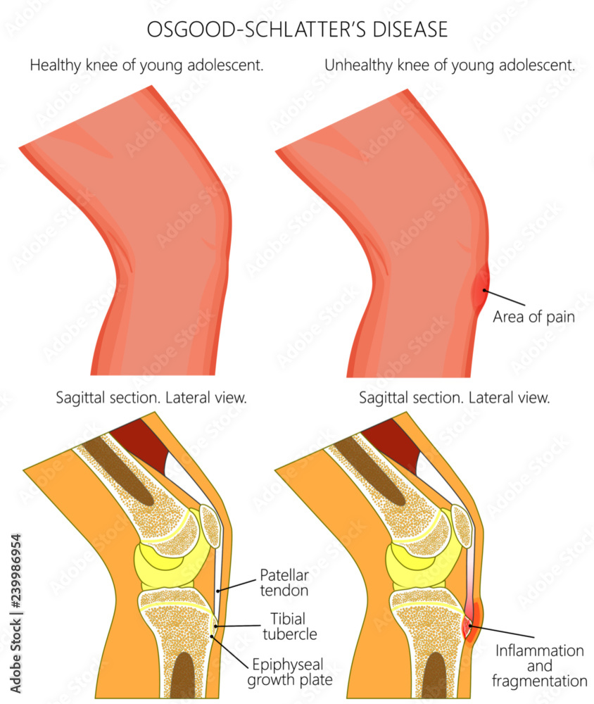 Vector illustration of a healthy adolescent knee and unhealthy knee ...