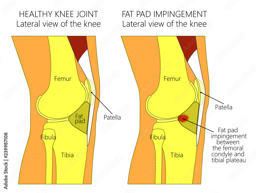 Vector illustration of a healthy human knee joint and unhealthy knee ...