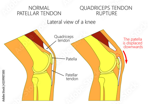 Vector illustration of a healthy knee joint and an unhealthy knee with ...