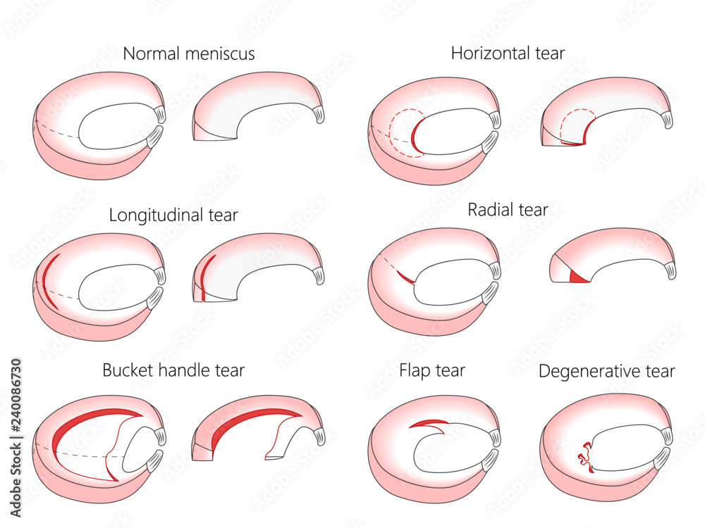 Vector illustration. Anatomy of a meniscus in the healthy human knee ...