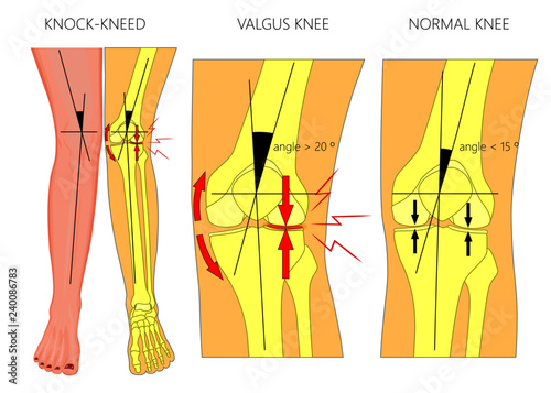 Vector illustration diagram. Shapes of human legs. Normal and curved ...