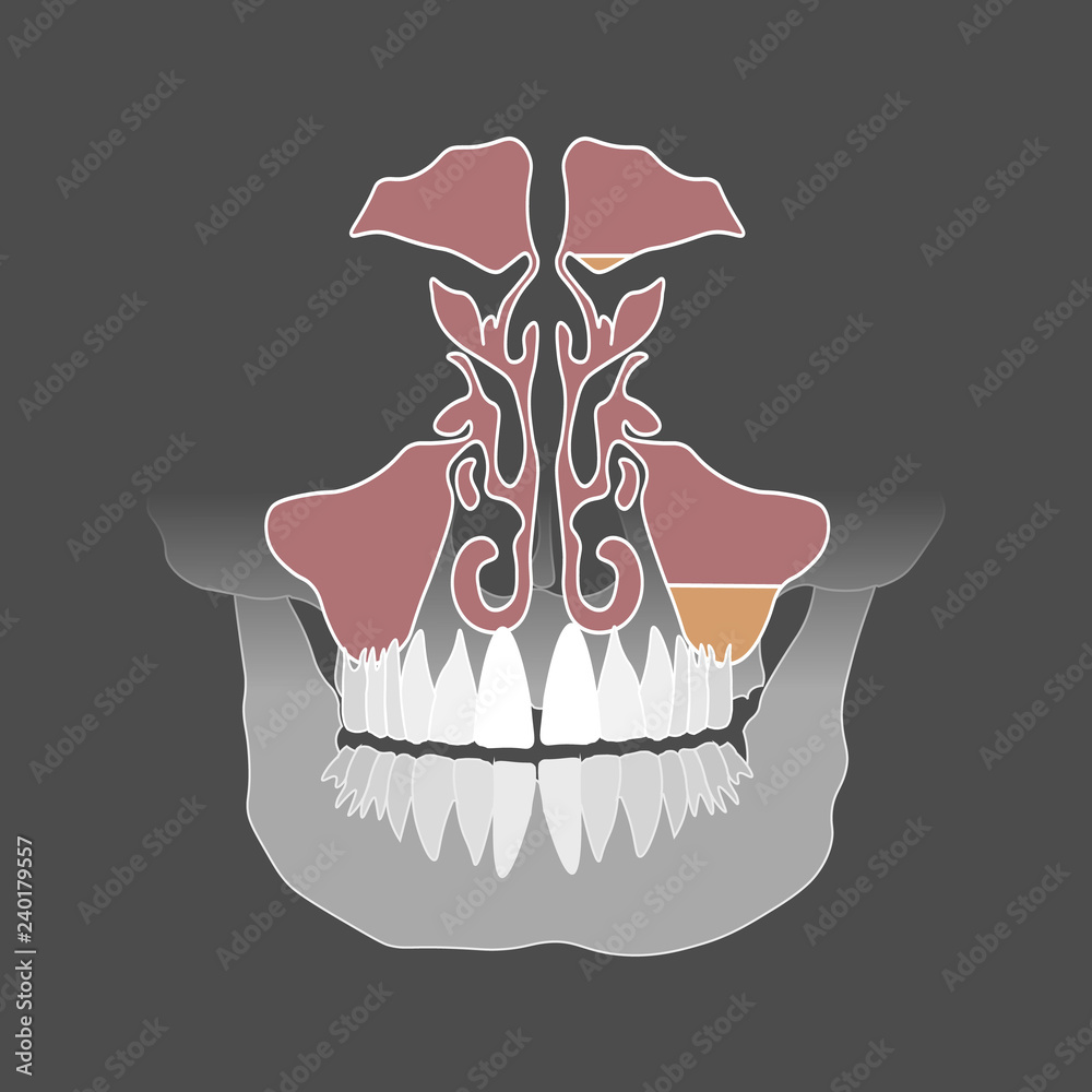 Flat style. Odontogenic sinusitis. Inflammation of the maxillary ...