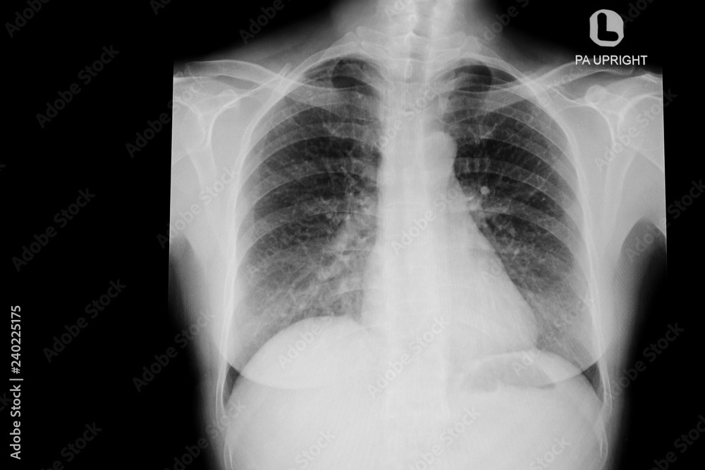 Normal chest x-ray image demonstrated heart,lungs,ribs,bones and ...