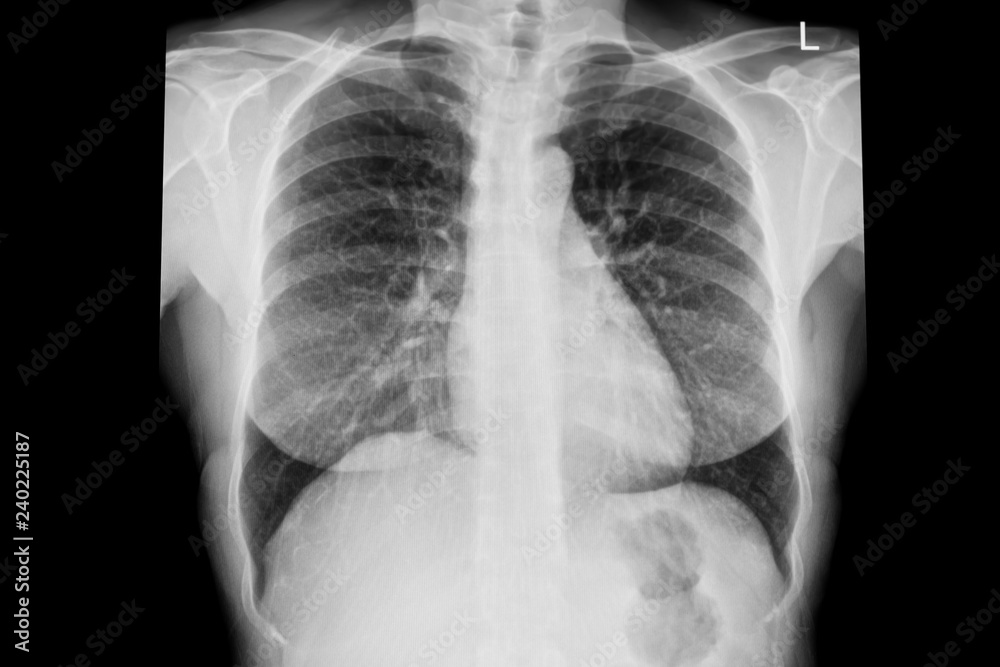 Foto de Stock Normal chest x-ray image demonstrated heart,lungs,ribs ...