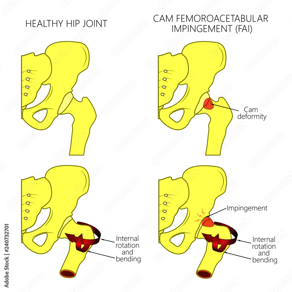 Vector illustration of a healthy human hip joint and hip with cam ...