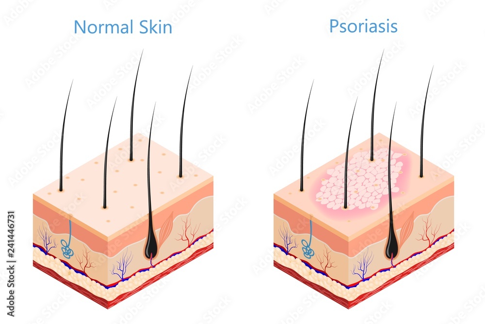 Cut human skin in isometric style on a white background isolated ...