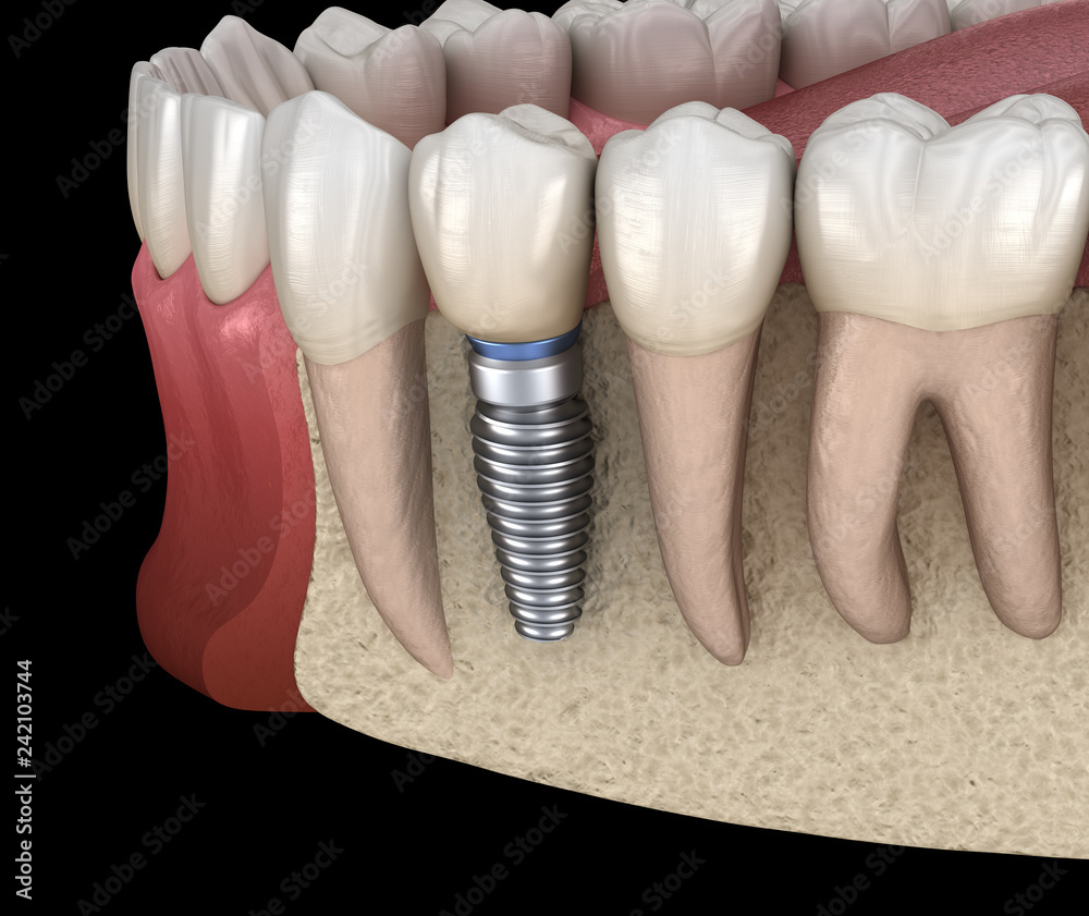 Premolar tooth recovery with implant. Medically accurate 3D ...