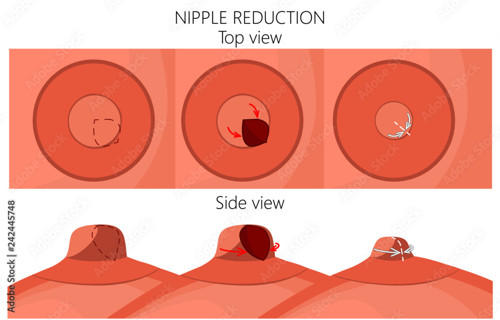 Vector Illustration Of The Big Nipple Reduction Before And After
