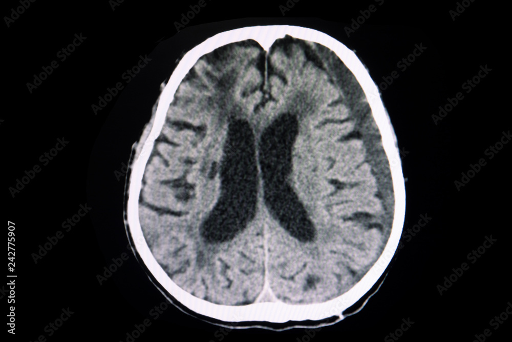 CT brain in trauma patient with subacute subdural hematoma Stock Photo ...