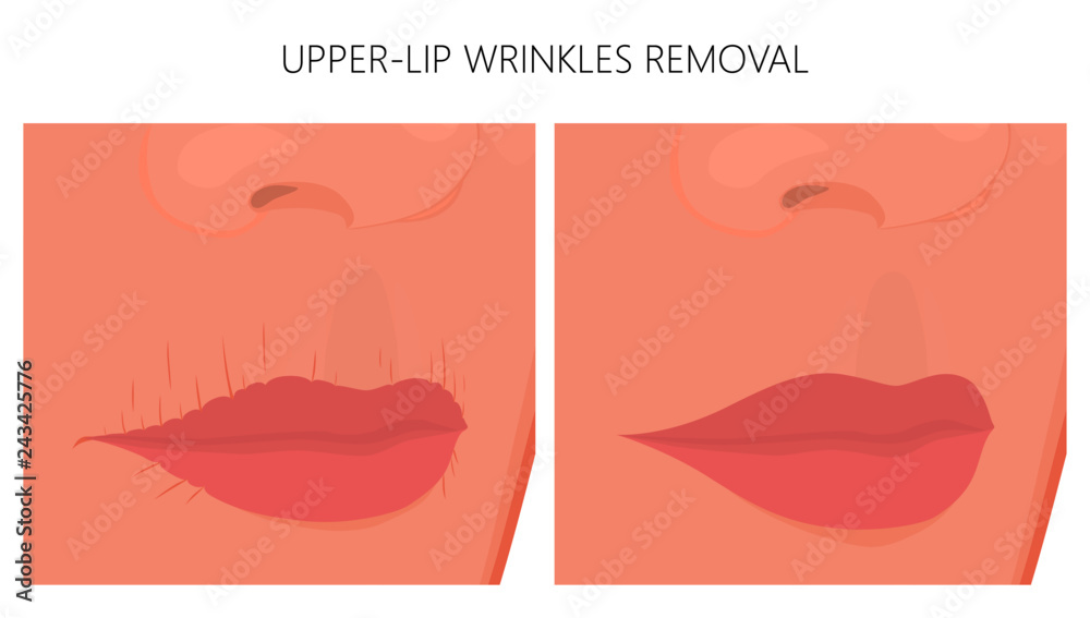 Vector illustration of upper-lip wrinkles removal before and after ...