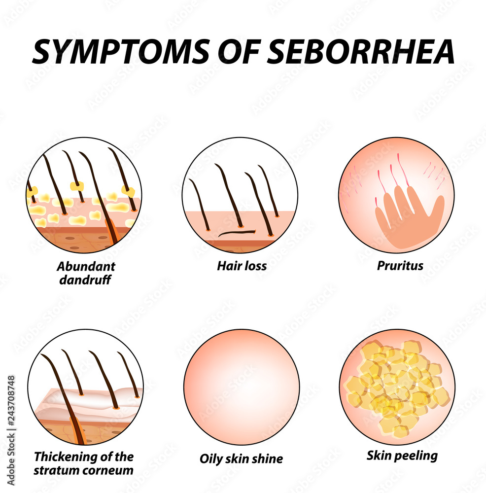 Symptoms of seborrhea. Seborrhea skin and hair. Dandruff, seborrheic ...
