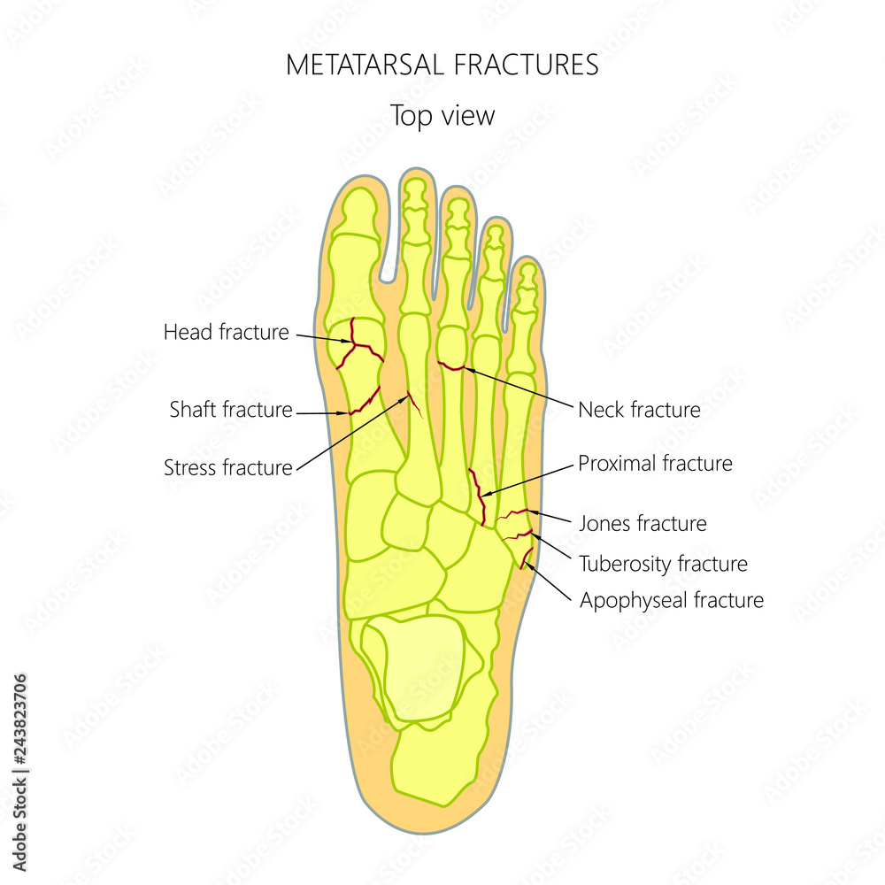Illustration (diagram) of Metatarsal fracture types. Stock Vector ...