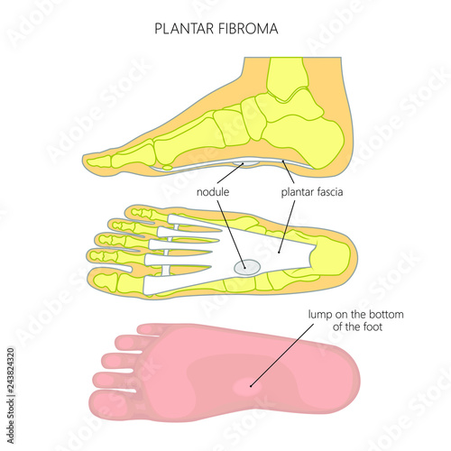 Vector diagram of plantar fibroma or fibromatosis. Tumor on the plantar ...