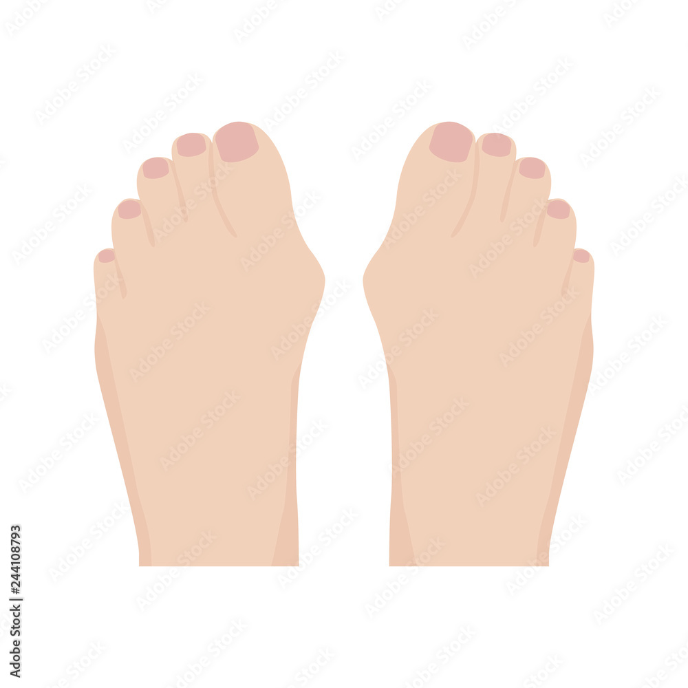 Hallux valgus - deformity bunion bone of toe. Orthopedic disease. Stock ...