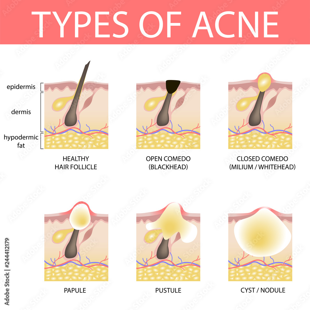 Medical vector illustration of different types of acne on human skin ...