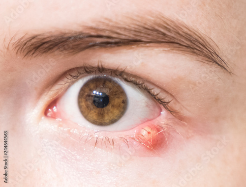 Eyelid abscess. Close up photo of young caucasian woman barley brown ...