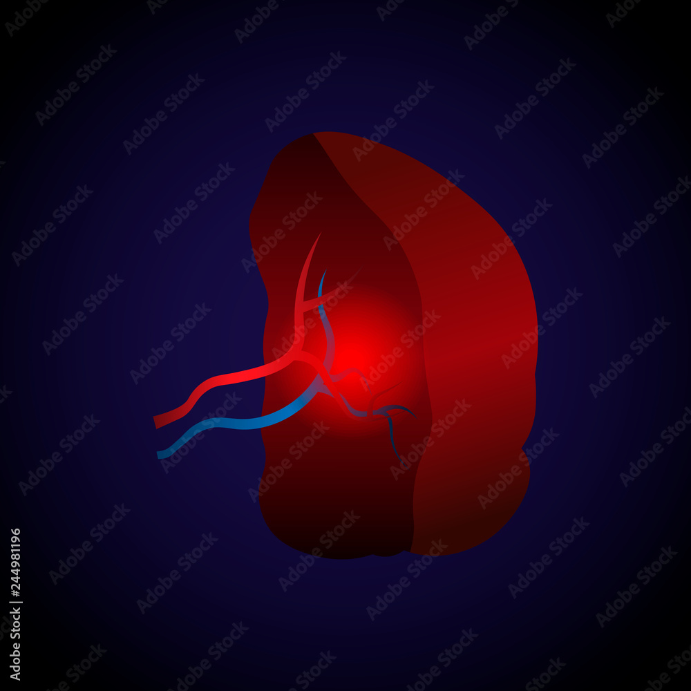 medical illustration of spleen disease with a pain point, abscess ...