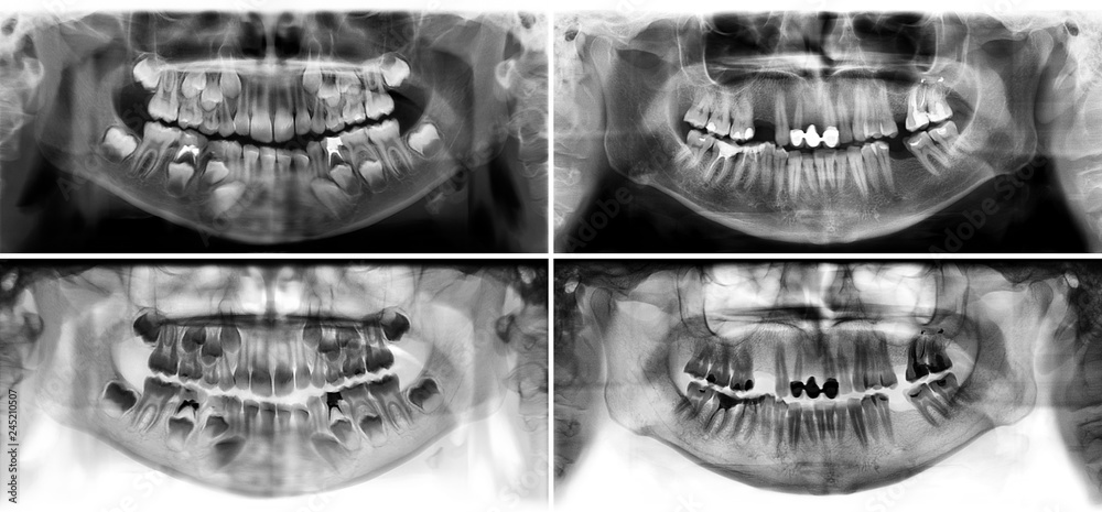 Panoramic radiograph is a scanning dental X-ray of the upper jaw ...