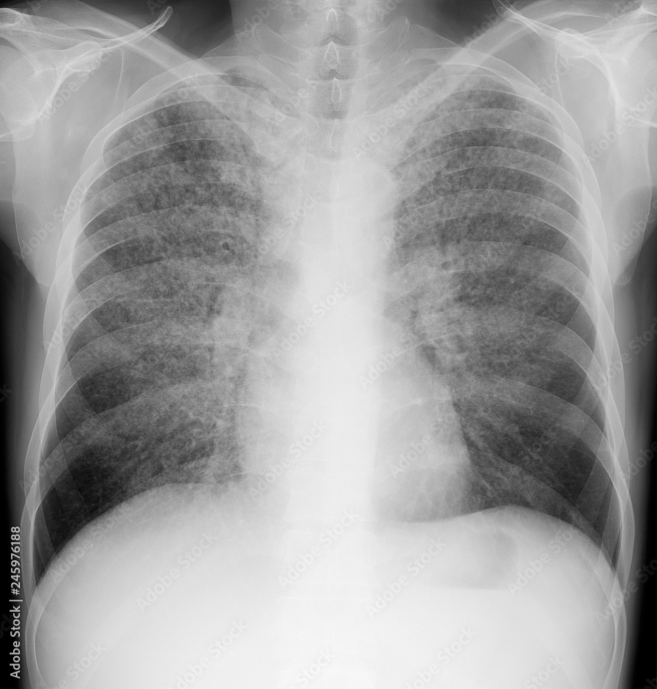 X-ray of the lungs. Miliary tuberculosis. Stock Photo | Adobe Stock