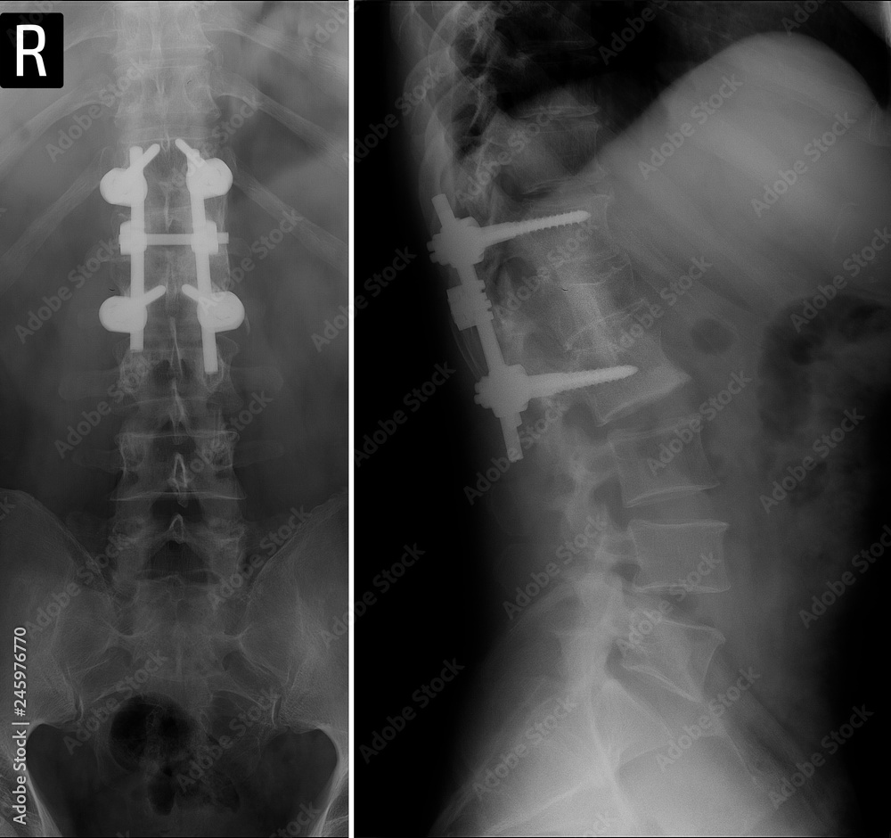 X-ray of the lumbar spine. Compression fracture of the vertebral body ...