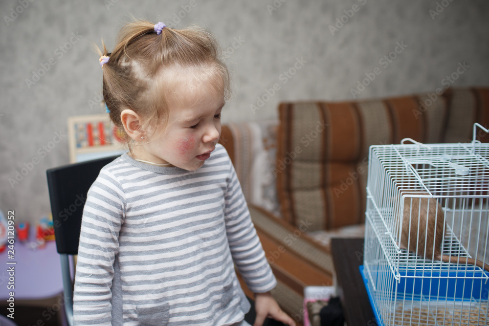a little beautiful girl has an allergy and a rash on her cheeks due to ...
