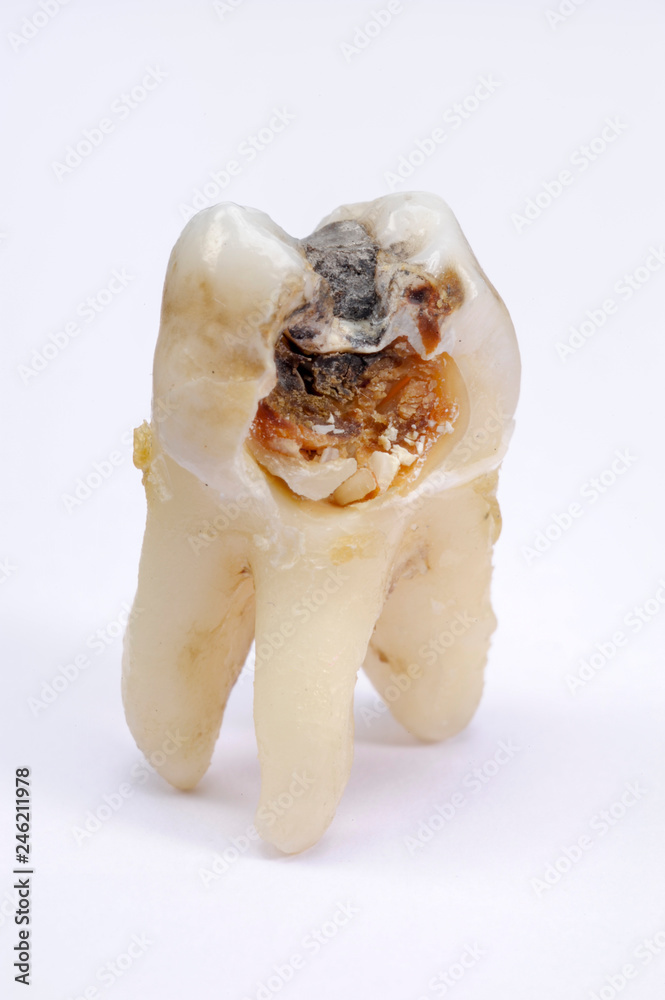 Stock-Foto „Backenzahn mit Karies extrahiert“ | Adobe Stock