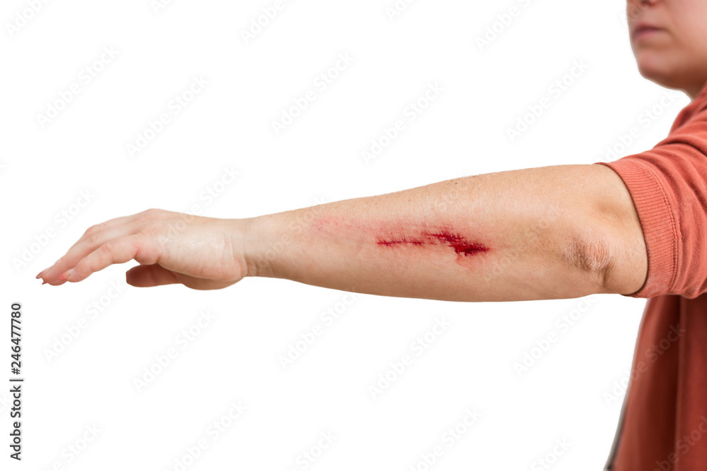 abrasion on a womans arm Stock Photo | Adobe Stock