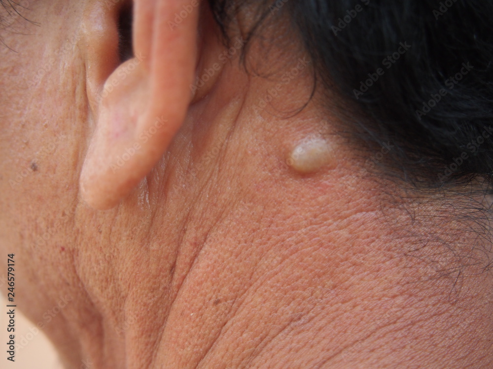 Stock-Foto „Neck is sebaceous cyst.“ | Adobe Stock