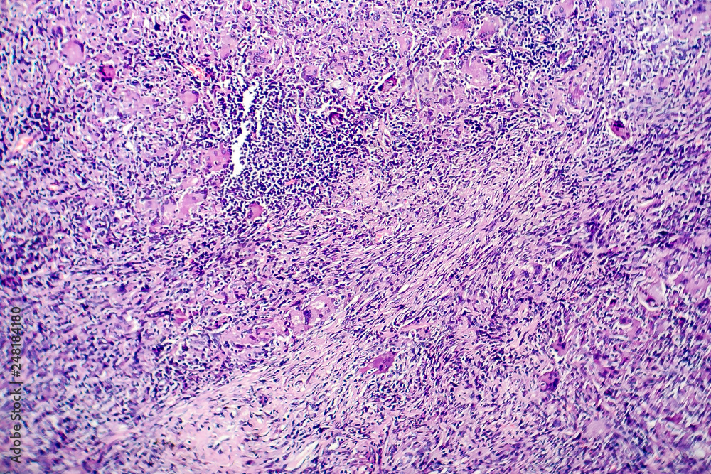 Histopathology of tuberculosis, light micrograph of tuberculosis lesion ...