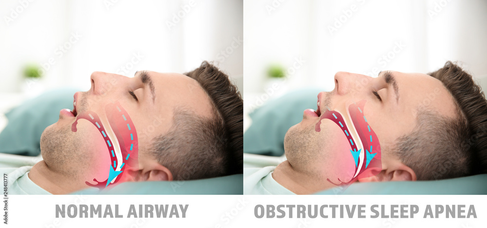 Illustrations showing difference between normal breathing and ...