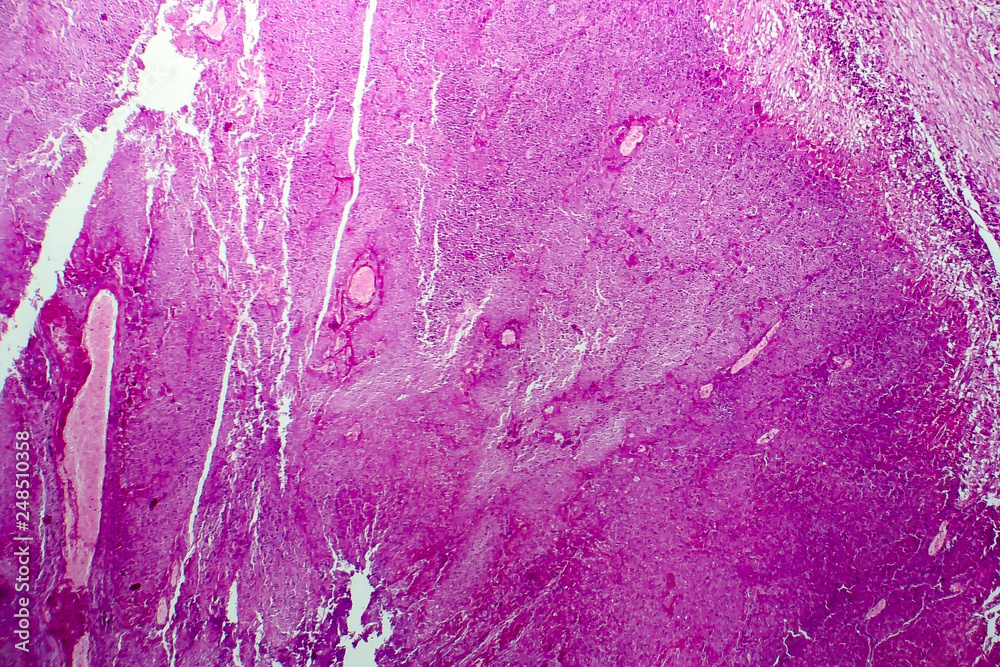 Stock-Foto „Caseation of human tuberculosis granuloma, light micrograph ...