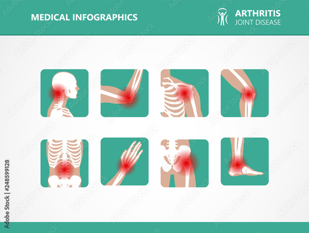 Rheumatism or rheumatic disorder medical set. Arthritis joint pain ...