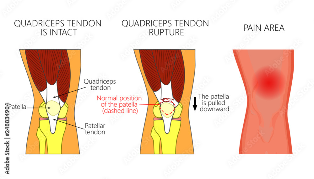 Vector illustration of a healthy knee joint and an unhealthy knee with ...