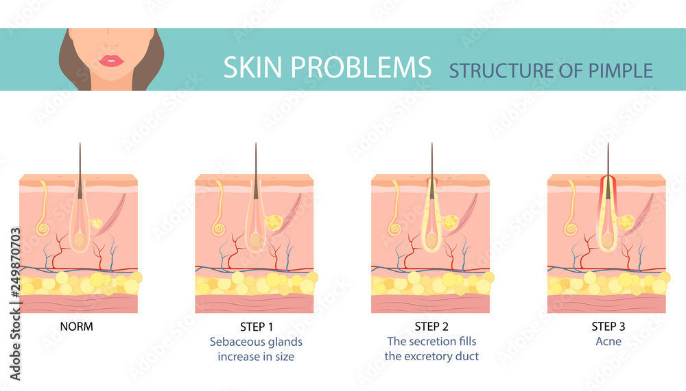 Stages of the acne formation in the human skin. Skin layer with acne ...
