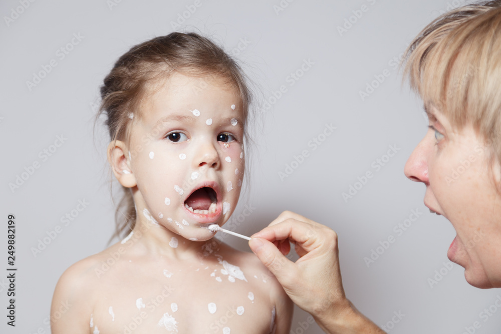 Foto Closeup face of cute little girl with varicella virus or ...