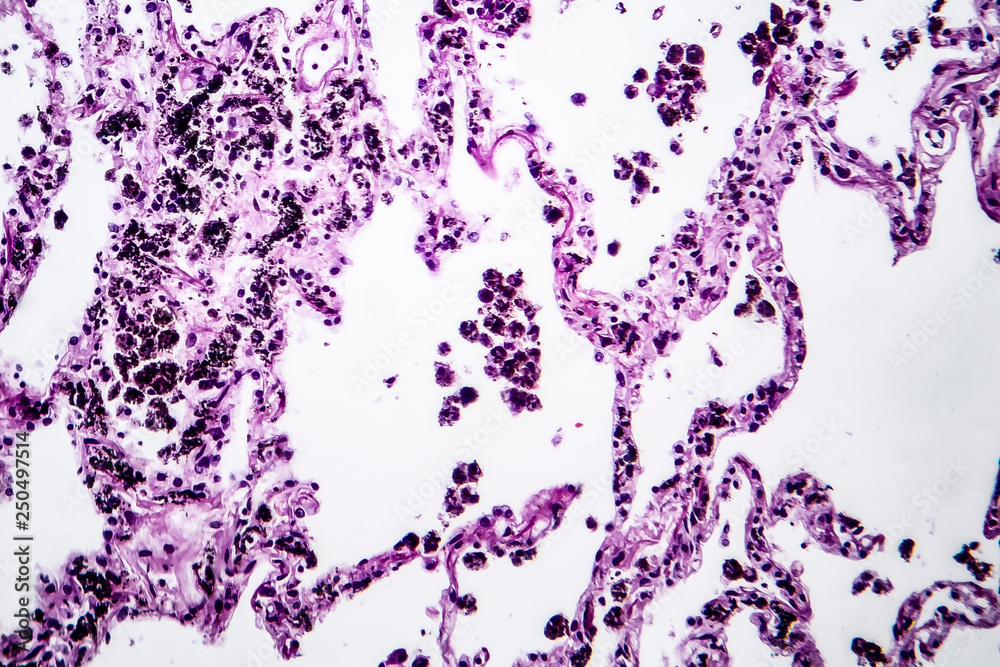 Histopathology of lung emphysema, light micrograph, photo under ...