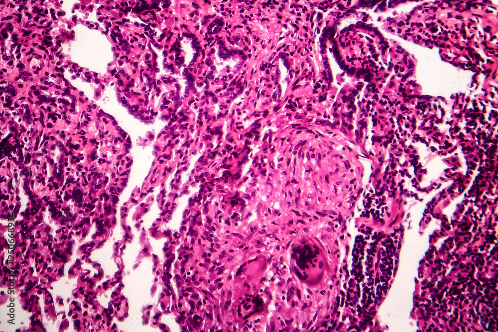 Caseous pneumonia, light micrograph, photo under microscope ...