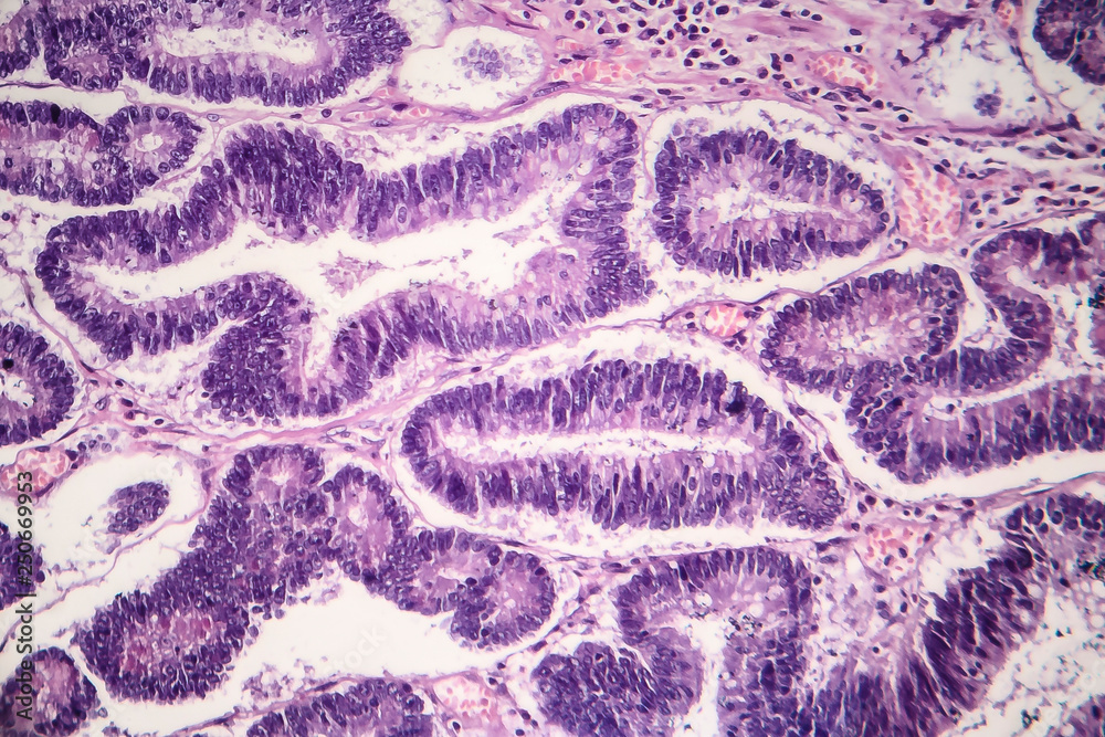 Histopathology of intestinal adenoma, light micrograph, photo under ...