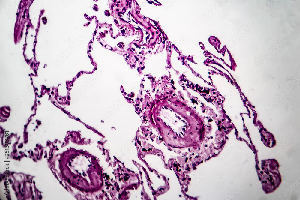 Histopathology of lung emphysema, light micrograph, photo under ...