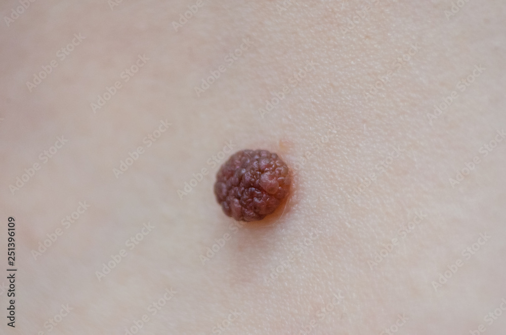 Inborn mole close up. Macro shot of benign skin lesion. Proliferation ...