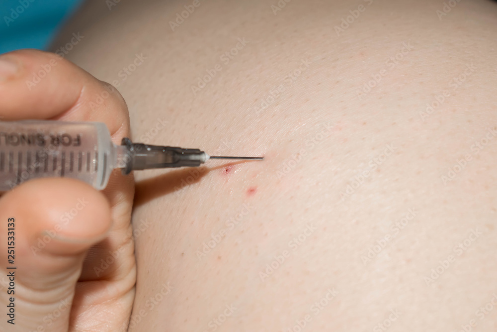 prick intramuscular injection with an antibiotic syringe into the ...