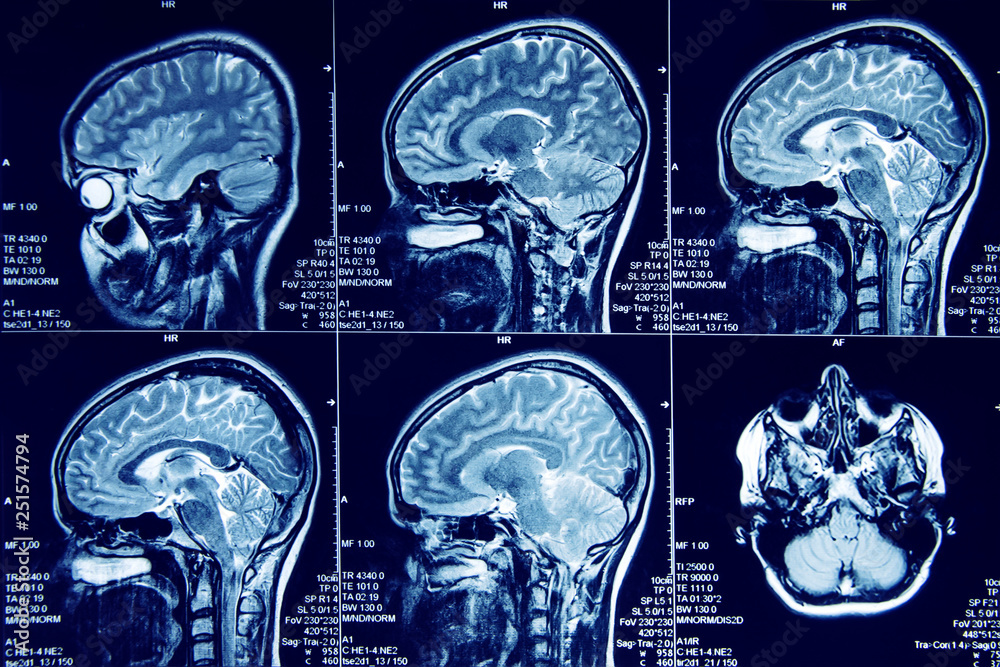 Photograph of magnetic resonance imaging of human brain in sagittal ...