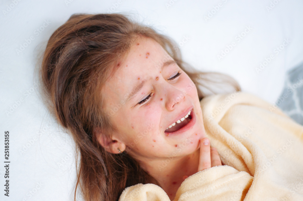 Closeup of cute sad crying little girl in bed. Varicella virus or ...
