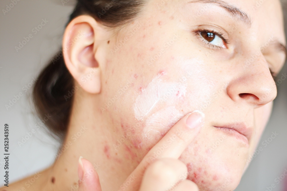 Acne on the face of young women. Improper therapy has led to a severe ...