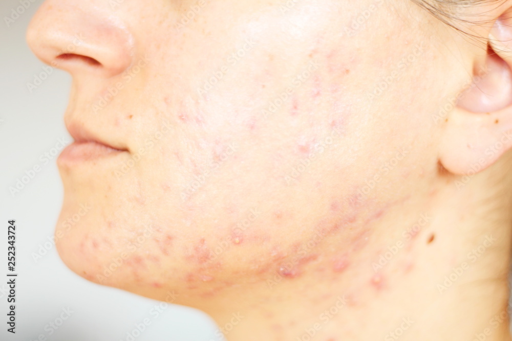 Acne on the face of young women. Improper therapy has led to a severe ...